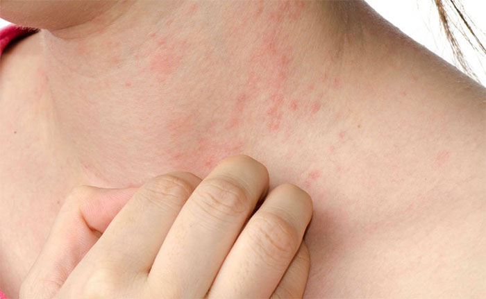 Sweat Rash Treatment and Prevention Tips : Pak101.com